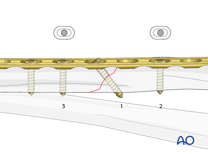 ORIF - Lag screw and plate fixation for Oblique simple fracture of the ...