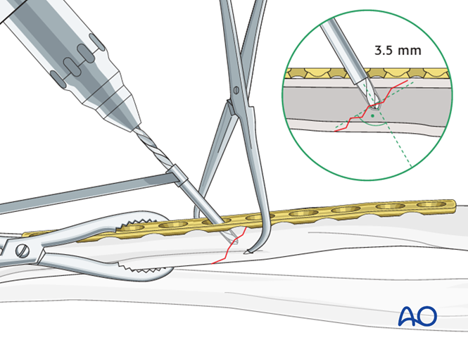 ORIF - Lag screw and plate fixation for Oblique simple fracture of the ...