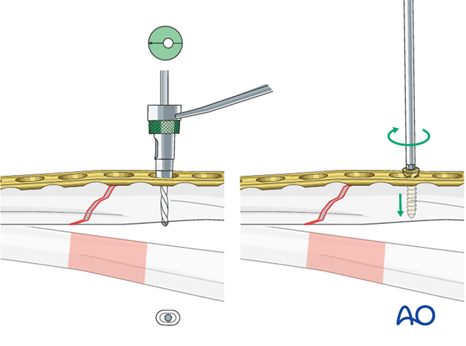 Oblique radial fracture: lag screw and plate fixation