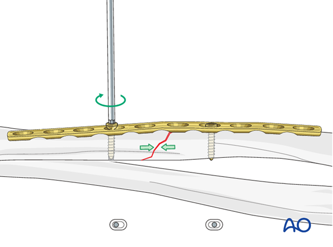 ORIF - Lag screw and plate fixation for Oblique simple fracture of the ...
