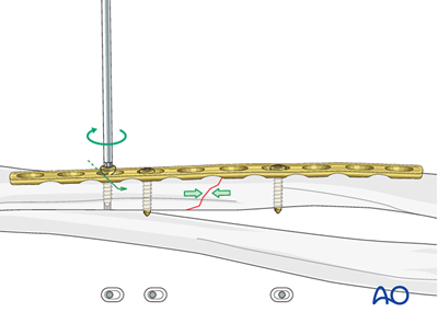 ORIF - Lag screw and plate fixation for Oblique simple fracture of the ...