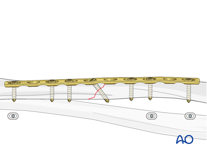 ORIF - Lag screw and plate fixation for Oblique simple fracture of the ...