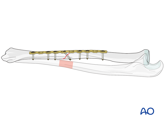 ORIF - Compression Plating for Simple fracture of the radius and the ulna