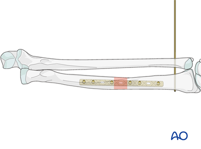 ORIF - Plating for Simple fracture of the radius, with dislocation of ...