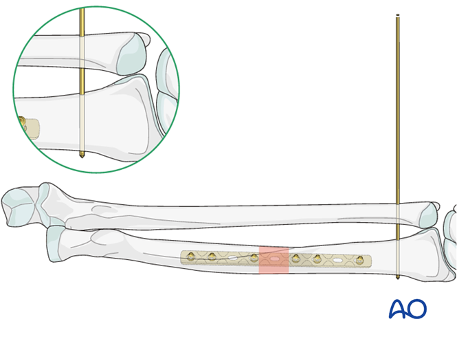 ORIF - Plating for Simple fracture of the radius, with dislocation of ...