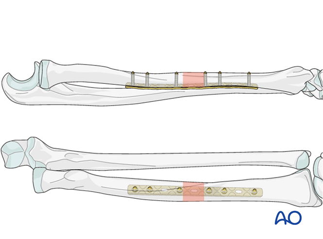 ORIF - Plating for Simple fracture of the radius, with dislocation of ...