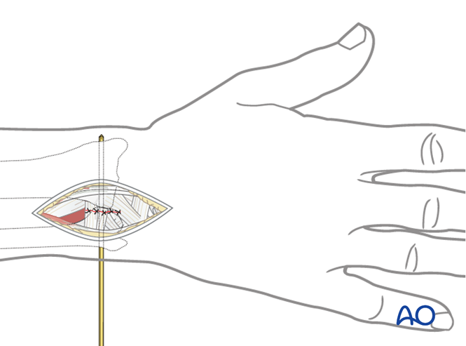 ORIF - Plating for Simple fracture of the radius, with dislocation of ...