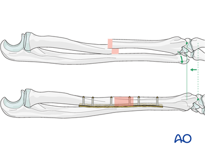 ORIF - Plating for Simple fracture of the radius, with dislocation of ...
