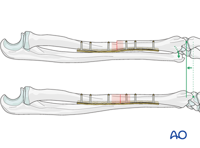ORIF - Plating for Simple fracture of the radius, with dislocation of ...