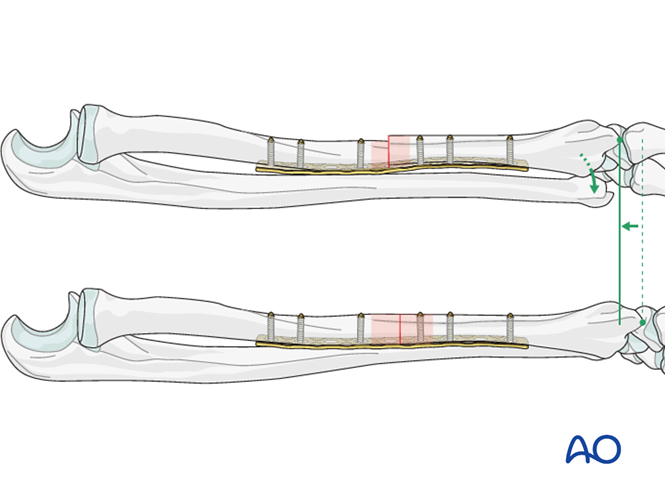 ORIF - Plating for Simple fracture of the radius, with dislocation of ...