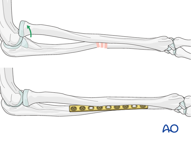 ORIF - Plating for Simple fracture of the ulna, with dislocation of ...