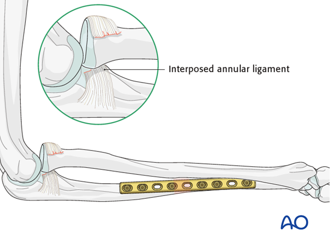 ORIF - Plating for Simple fracture of the ulna, with dislocation of ...
