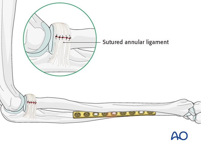 Radial head stabilization (Monteggia fracture-dislocation)