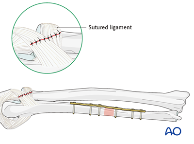 ORIF - Plating for Simple fracture of the ulna, with dislocation of ...