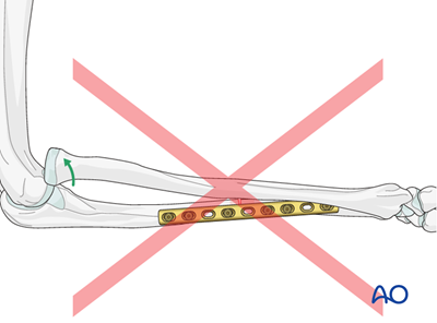 ORIF - Plating for Simple fracture of the ulna, with dislocation of ...