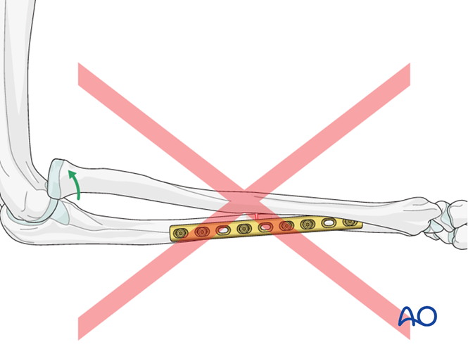 ORIF - Plating for Simple fracture of the ulna, with dislocation of ...