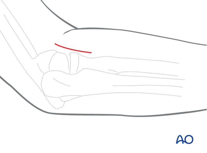 ORIF - Plating for Simple fracture of the ulna, with dislocation of ...