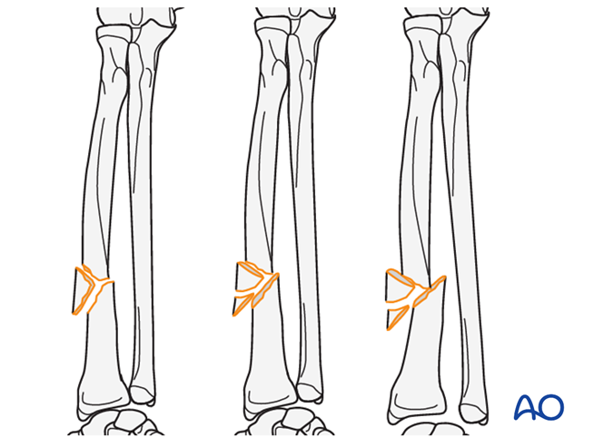 ORIF - Compression Plating for Wedge fracture of the radius with no ...