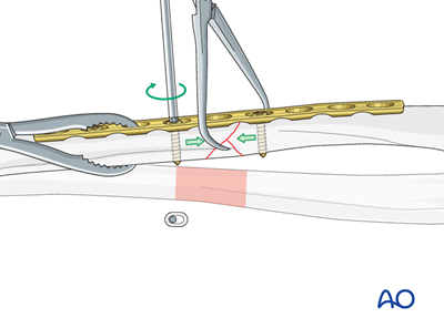 Radial wedge fracture: compression plating (and lag screw)