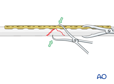ORIF - Compression Plating for Wedge fracture of the radius with no ...