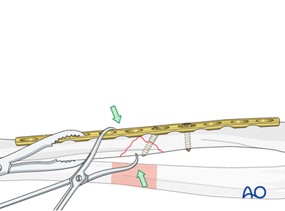 Radial wedge fracture: compression plating (and lag screw)