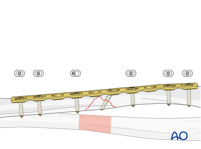 Radial wedge fracture: compression plating (and lag screw)
