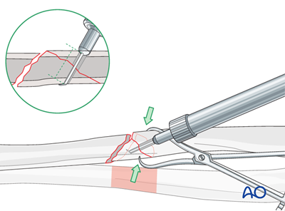 Radial wedge fracture: compression plating (and lag screw)