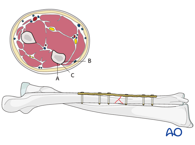 ORIF - Compression Plating for Wedge fracture of the ulna with no ...