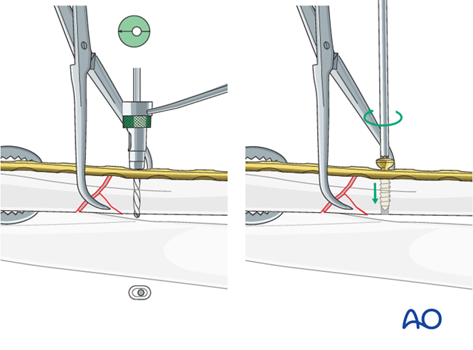 ORIF - Compression Plating for Wedge fracture of the ulna with no ...