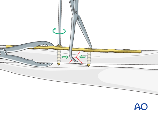 ORIF - Compression Plating for Wedge fracture of the ulna with no ...