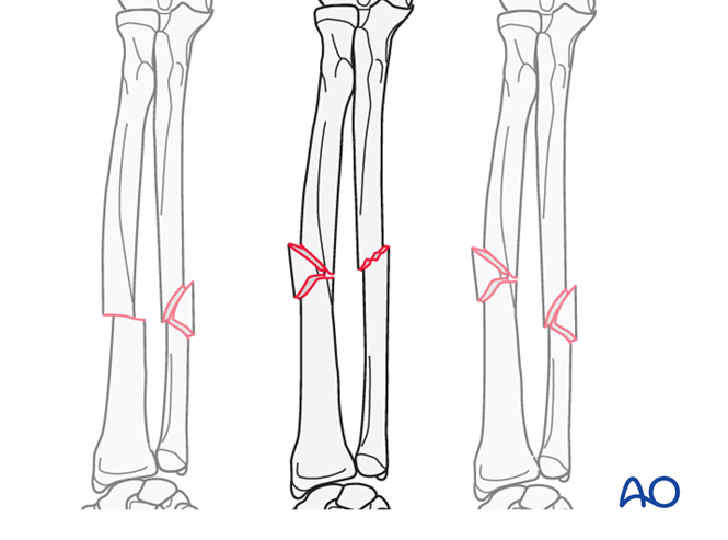 ORIF - Compression plating for Wedge fracture of one bone, with a ...