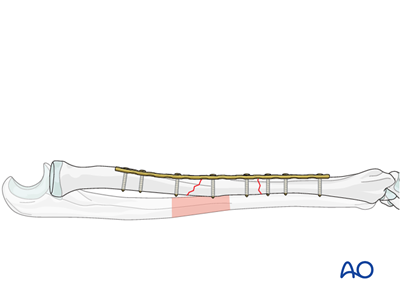 ORIF - Plating of one or both bones for Multifragmentary radial ...