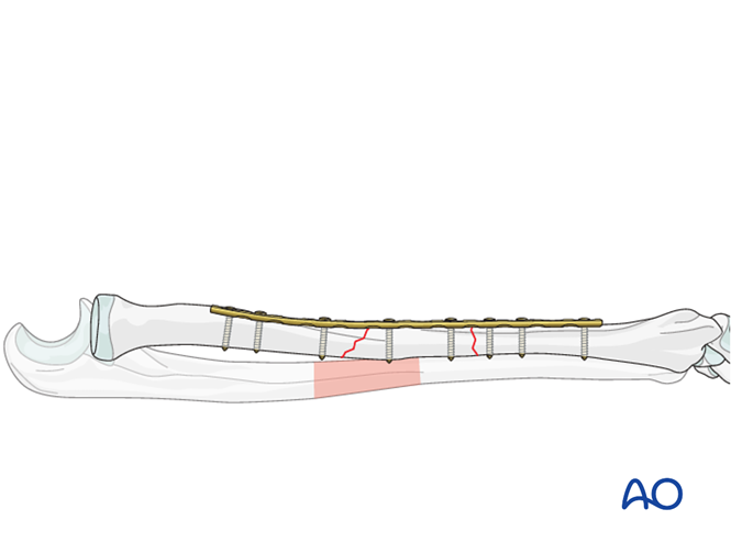 ORIF - Plating of one or both bones for Multifragmentary radial ...