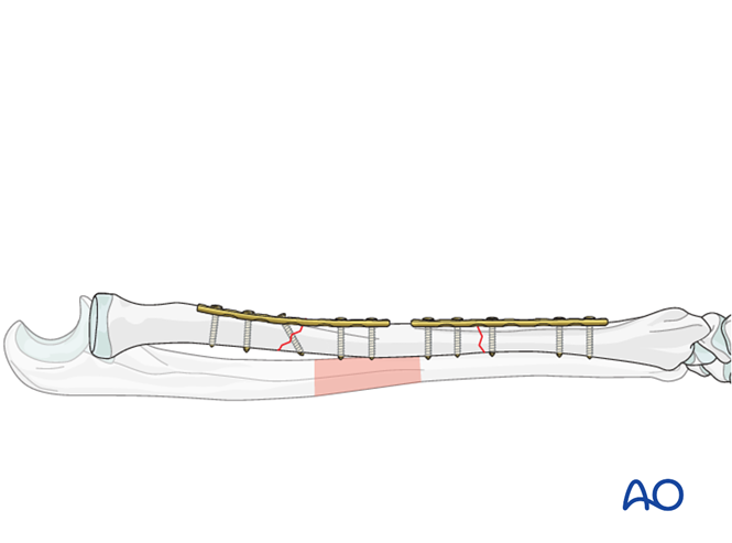 Segmental radial fracture: compression plating