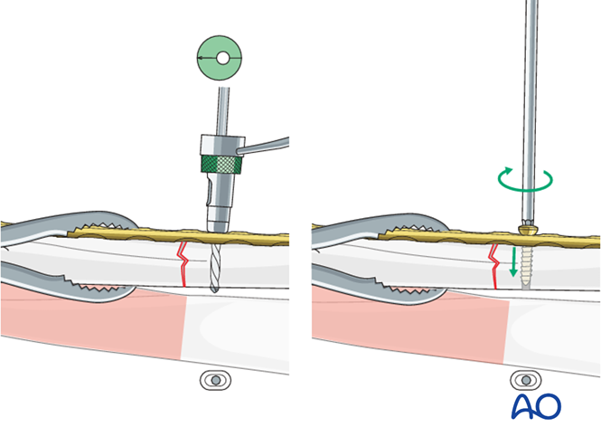 Segmental ulnar fracture: compression plating