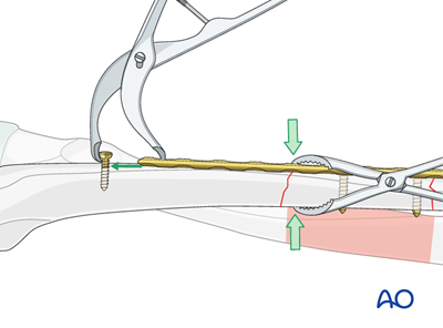 Segmental ulnar fracture: compression plating