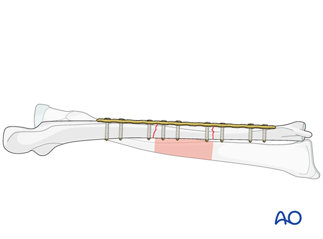 ORIF - Compression plating for Multifragmentary, intact segmental ...