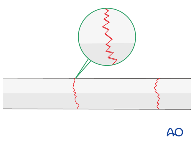 Segmental radial fracture: compression plating