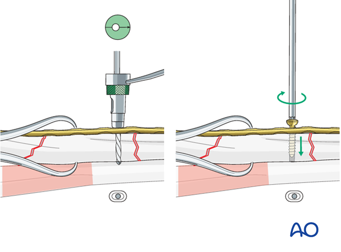 Segmental radial fracture: compression plating