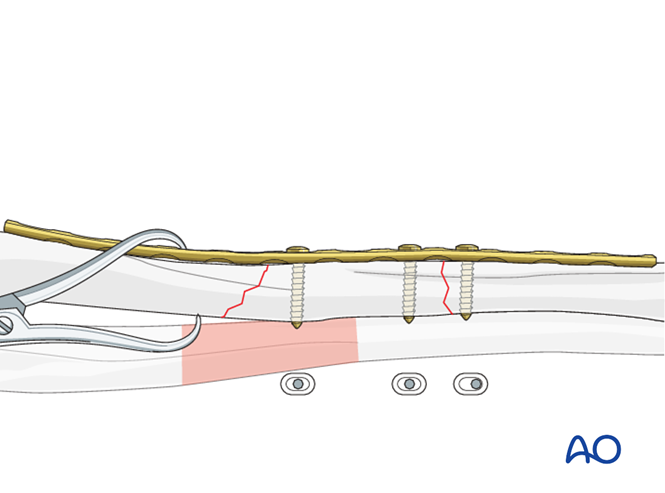 Segmental radial fracture: compression plating