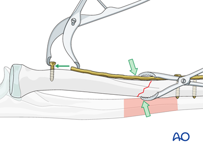 Segmental radial fracture: compression plating