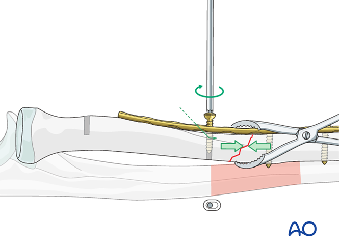Segmental radial fracture: compression plating