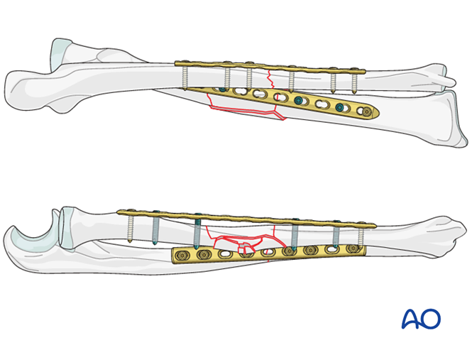 ORIF - Plating of one or both bones for Multifragmentary radial ...