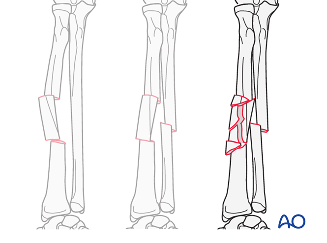 ORIF - Plating of one or both bones for Multifragmentary radial ...