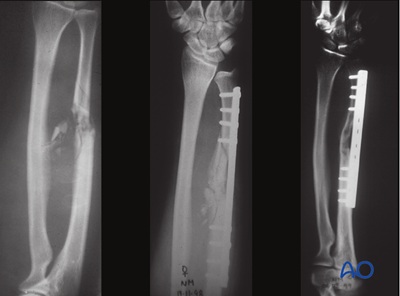 ORIF - Plating of one or both bones for Multifragmentary radial ...