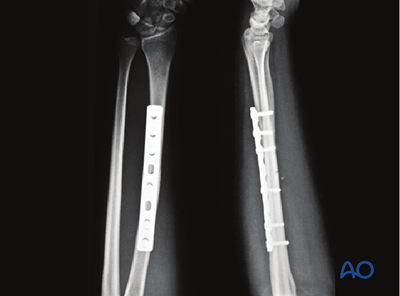 ORIF - Plating for Simple fracture of the radius, with dislocation of ...