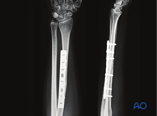 ORIF - Plating for Simple fracture of the radius, with dislocation of ...