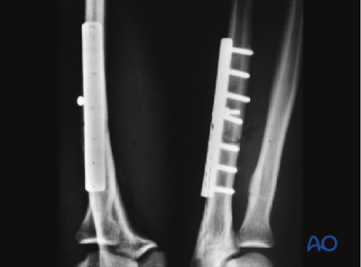 ORIF - Plating for Simple fracture of the ulna, with dislocation of ...