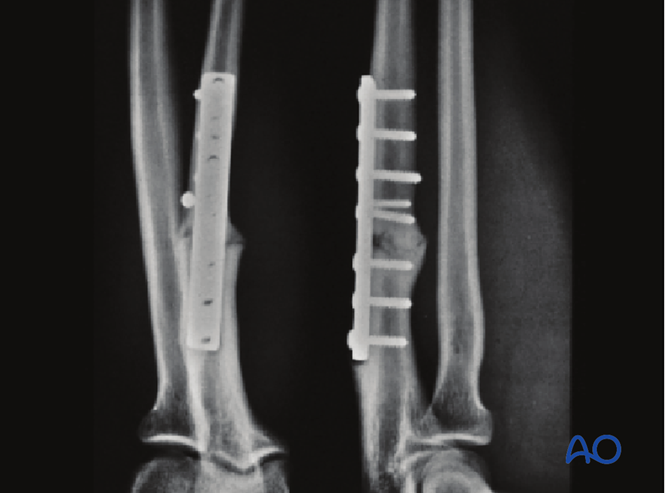 ORIF - Plating for Simple fracture of the ulna, with dislocation of ...