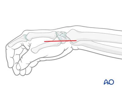 Direct approach to the radial styloid